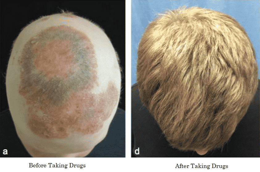 [Breakthrough] Drug Enables A Bald Man Having Head With Full Of Hair ...